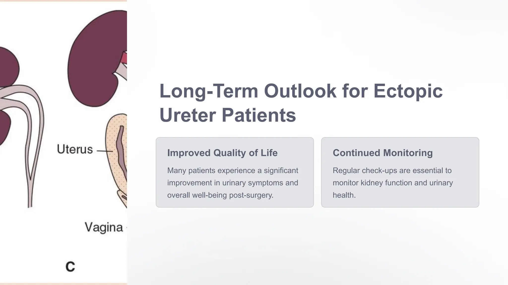 Understanding basics of -Ectopic-Ureter.pptx
