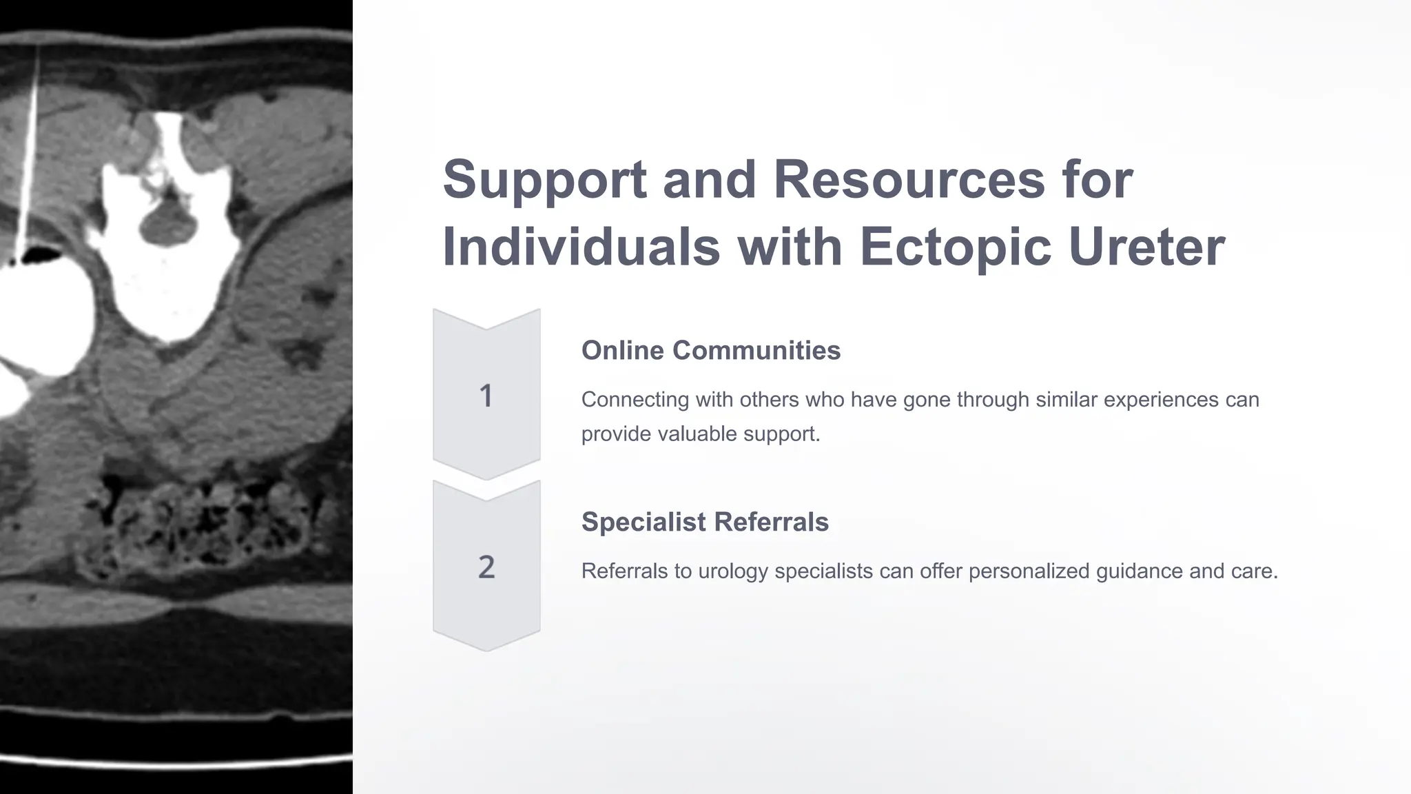 Understanding basics of -Ectopic-Ureter.pptx