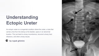 Understanding basics of -Ectopic-Ureter.pptx