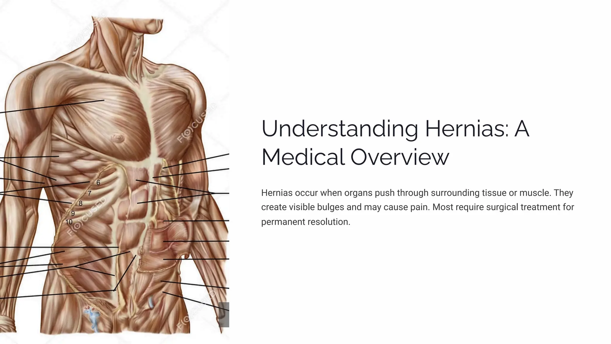 Understanding Hernias: A Medical Overview | PDF
