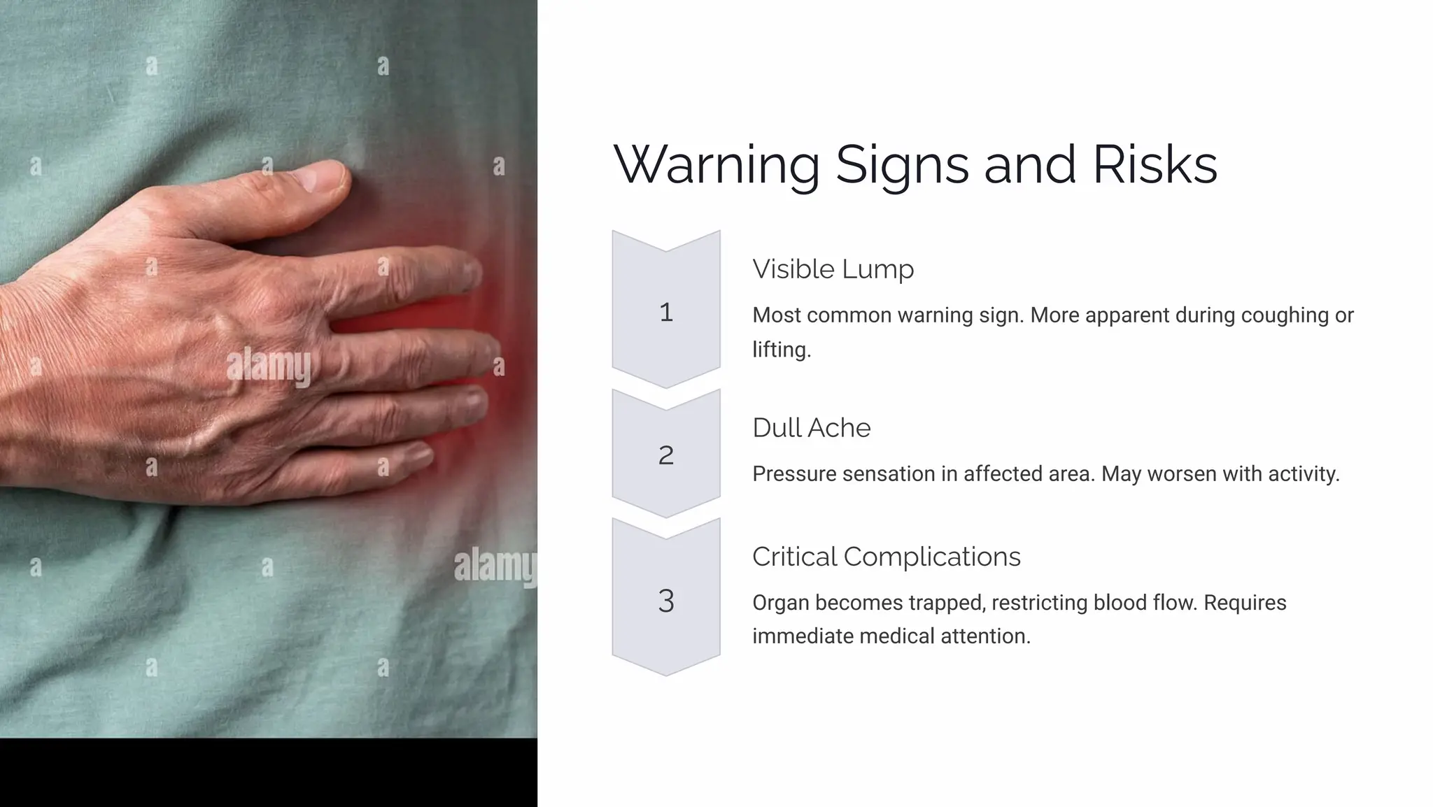 Understanding Hernias: A Medical Overview | PDF