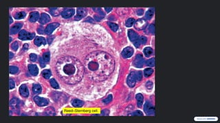 Understanding-Lymphomas-Hodgkin-and-Non-Hodgkin-Lymphoma-Explained (1).pptx