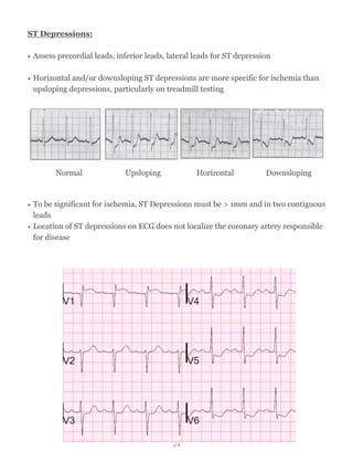 Understanding Medicine - Complete ECG Guide by Dr. Sam Gharbi | PDF