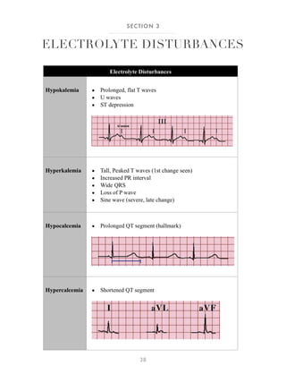 Understanding Medicine - Complete ECG Guide by Dr. Sam Gharbi | PDF