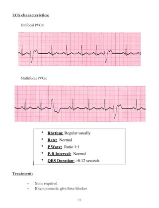 Understanding Medicine - Complete ECG Guide by Dr. Sam Gharbi | PDF