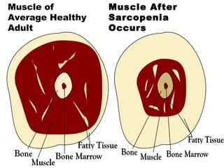 Understanding Sarcopenia | PPT