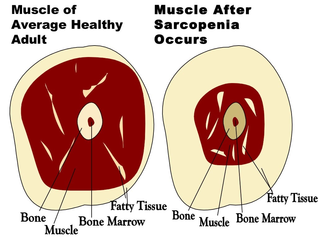 Understanding Sarcopenia