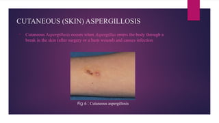 Understanding Aspergillosis, Causes, Symptoms, Diagnosis, and Treatment ...