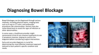 Understanding Bowel Blockage Operation - Symptoms & Solutions.pdf