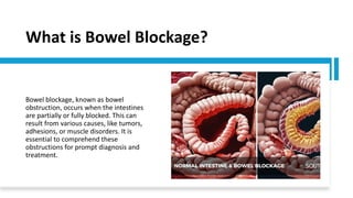 Understanding Bowel Blockage Operation - Symptoms & Solutions.pdf