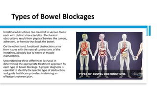 Understanding Bowel Blockage Operation - Symptoms & Solutions.pdf