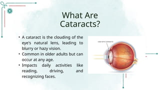Understanding Cataracts: Symptoms & Treatment | PPT