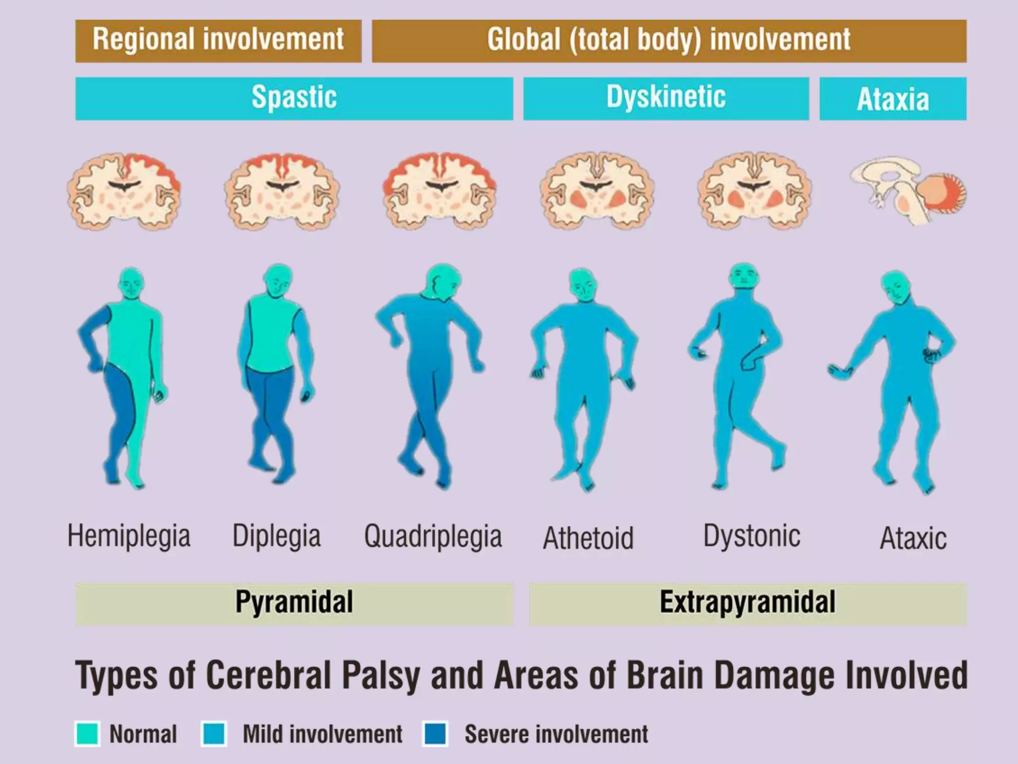 Understanding cerebral palsy | PPT