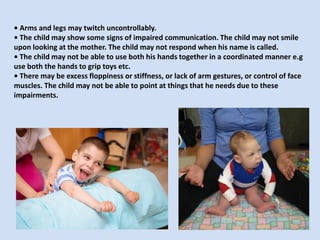 Understanding cerebral palsy | PPTX