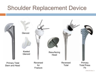 Understanding Chronic Shoulder Pain | PPT
