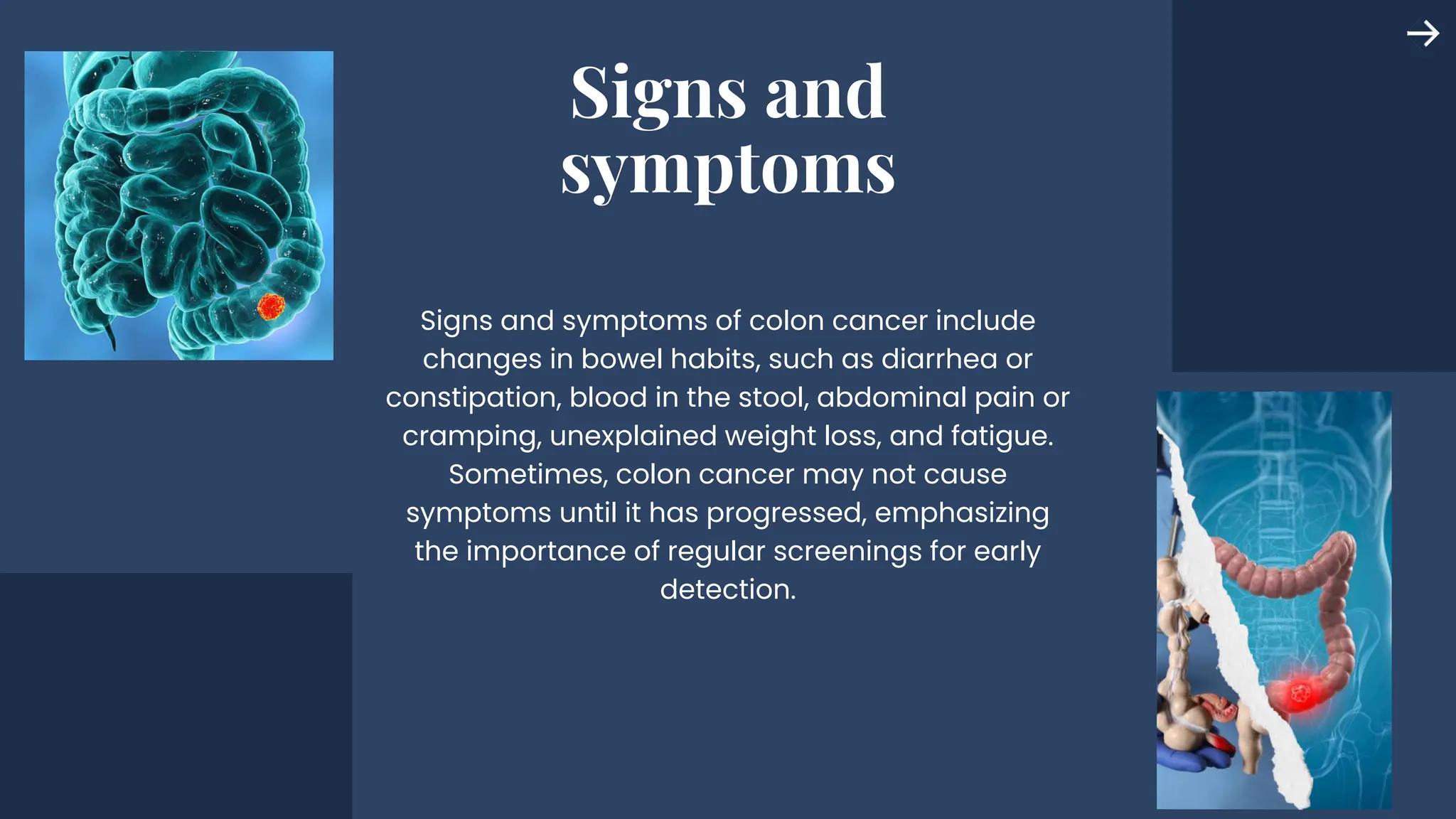 Understanding colon cancer by Dr Dodul mondal | PPT | Free Download
