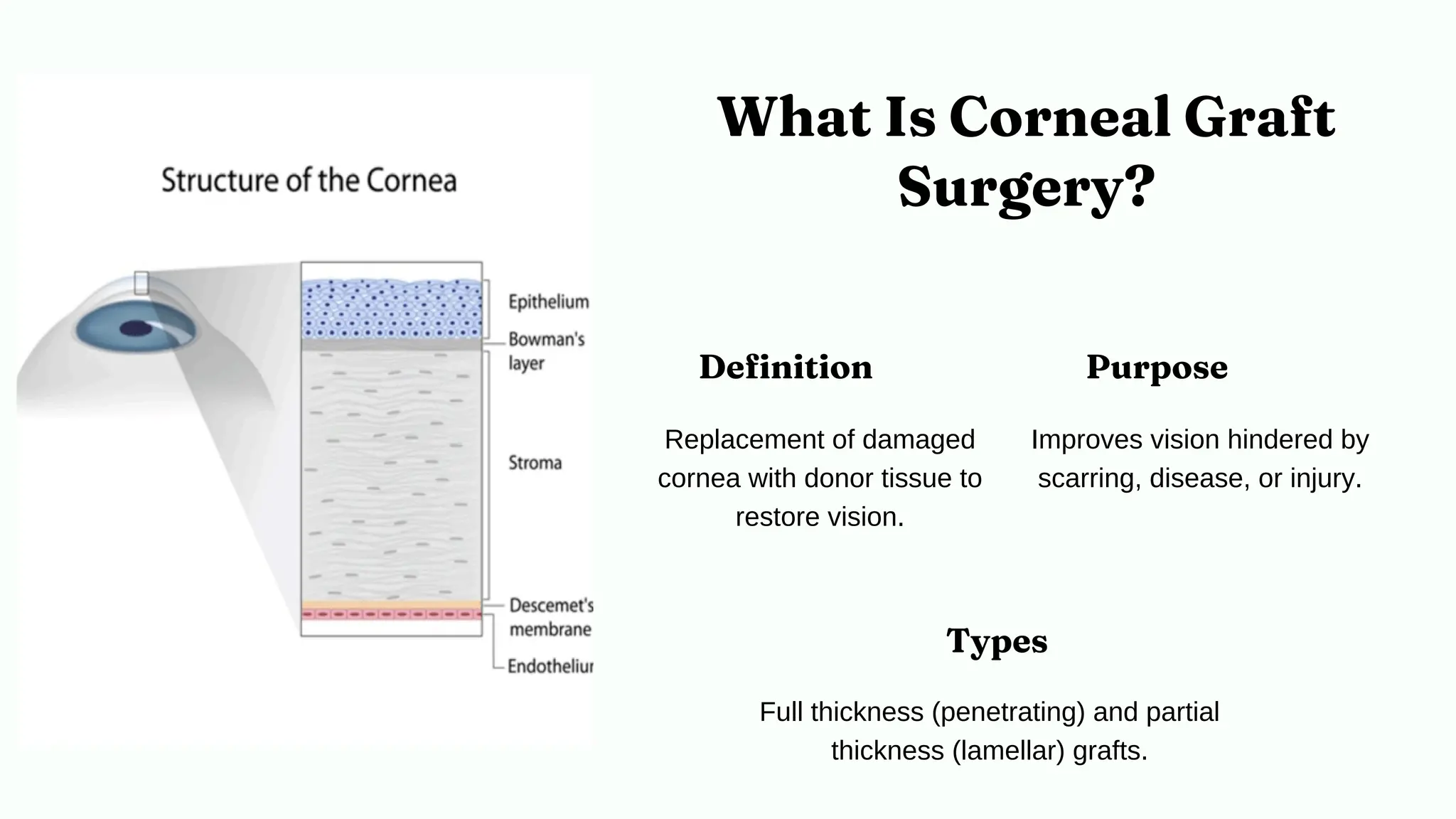 Understanding Corneal Graft Surgery by Nexus Eye Care | PDF