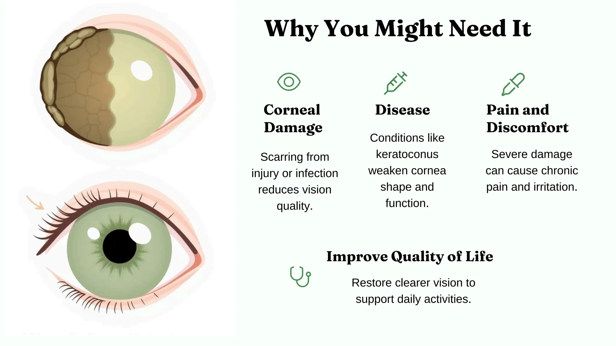 Understanding Corneal Graft Surgery by Nexus Eye Care | PDF