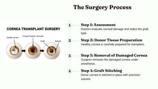 Understanding Corneal Graft Surgery by Nexus Eye Care | PDF