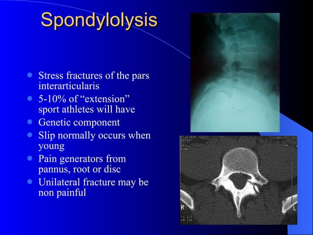 Understanding disorders of the spine| anatomy of the spine | chronic ...