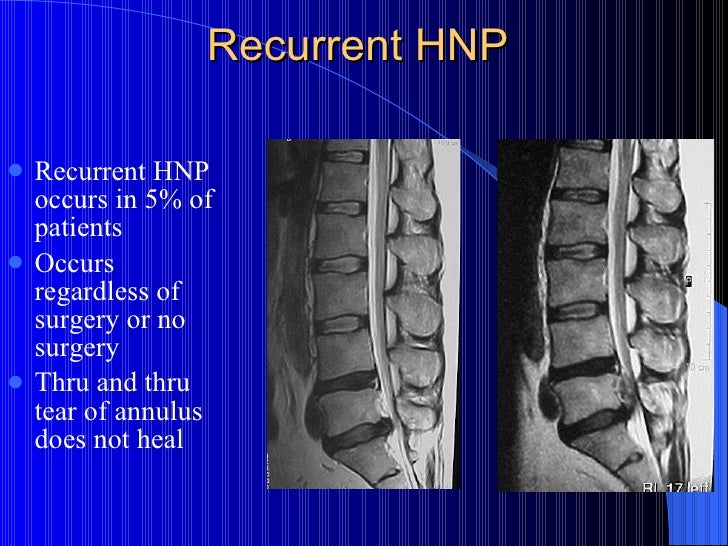 Understanding disorders of the spine| anatomy of the spine | chronic