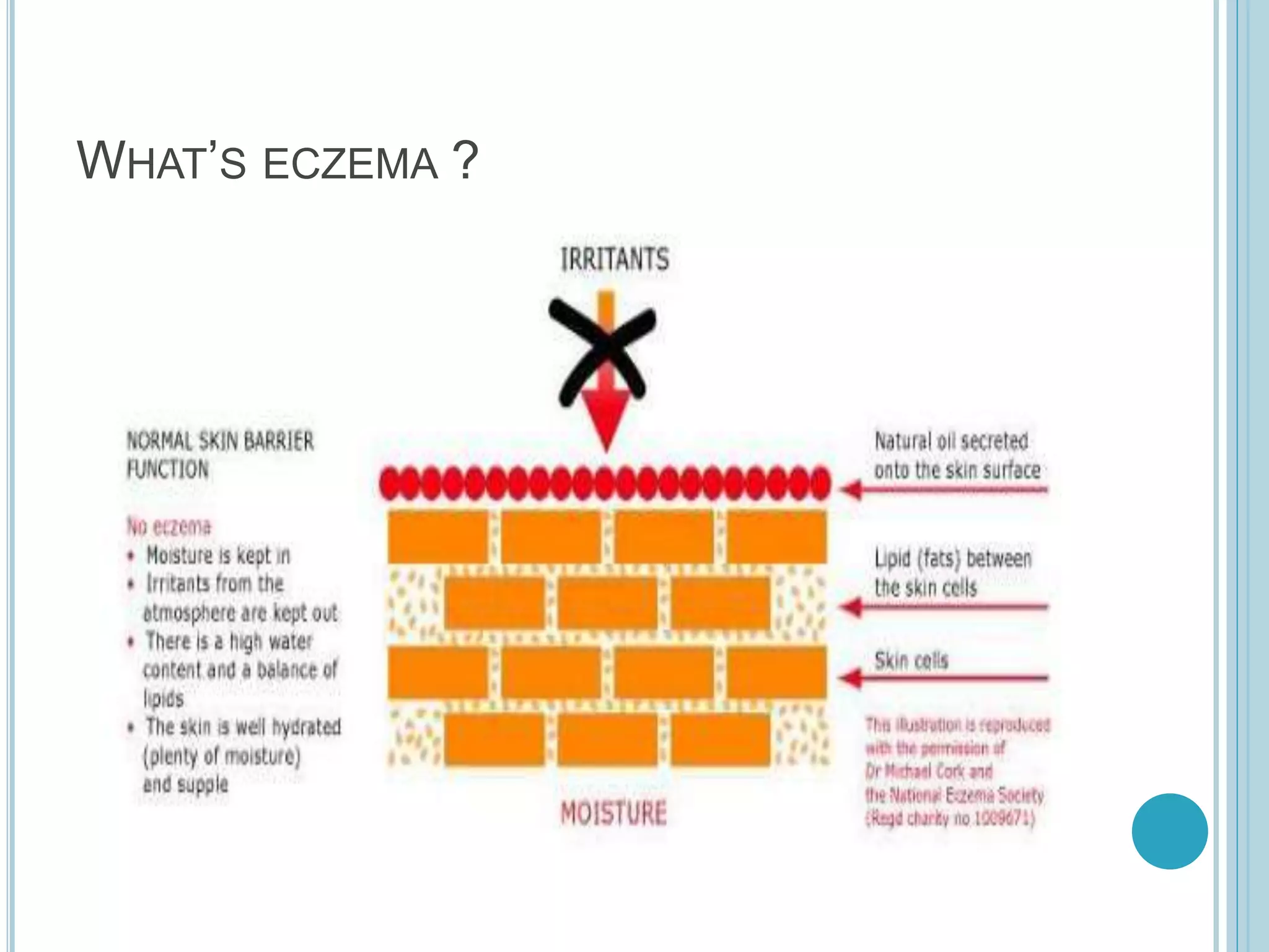 Understanding eczema | PPT