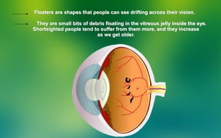 Understanding eye floaters | PDF