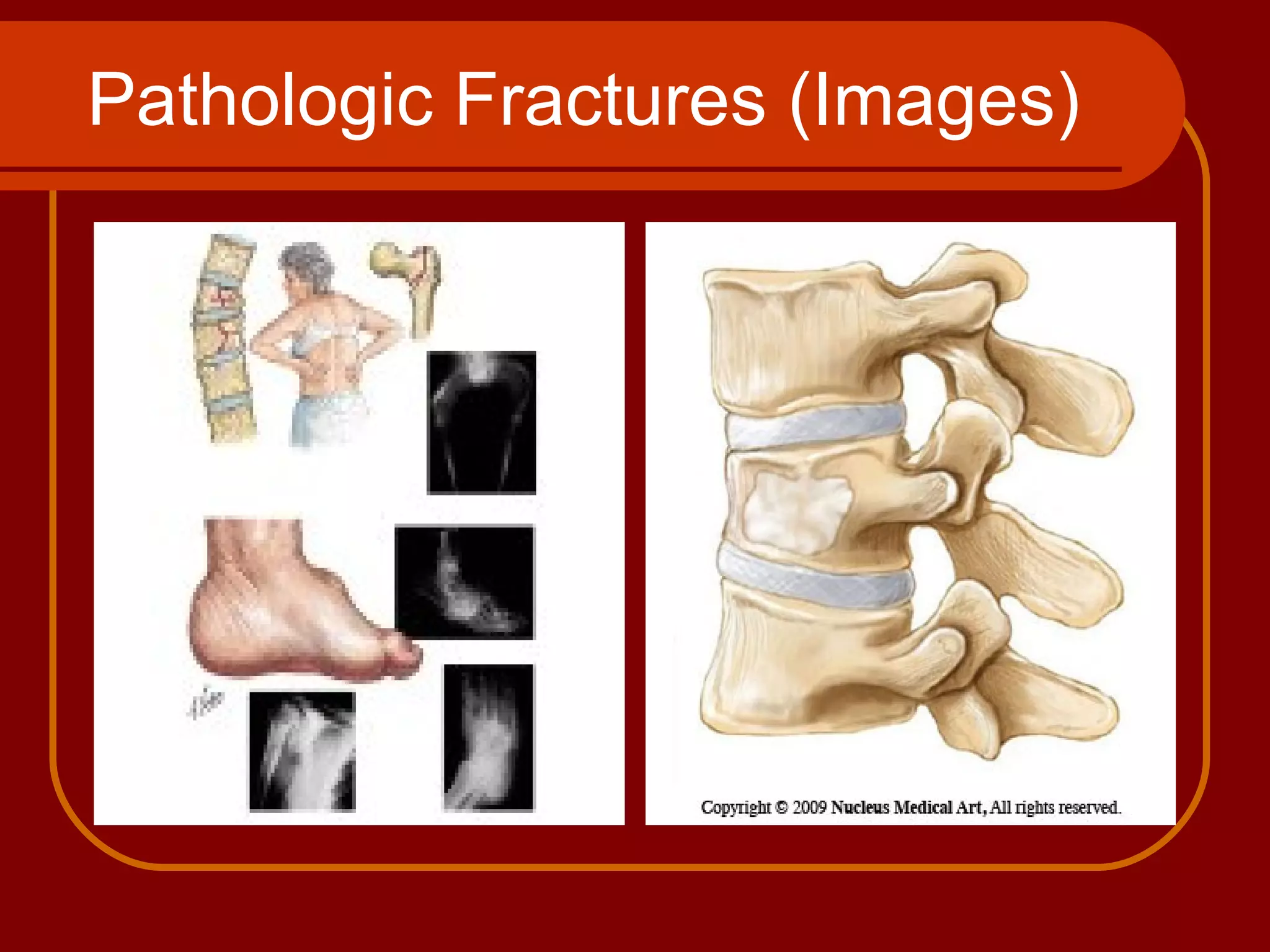 Understanding Fractures | PPT