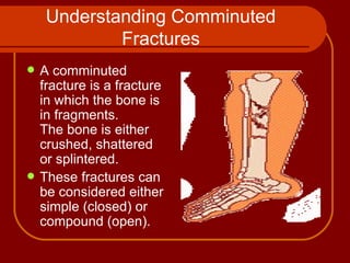 Understanding Fractures | PPT