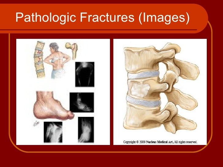 Understanding Fractures