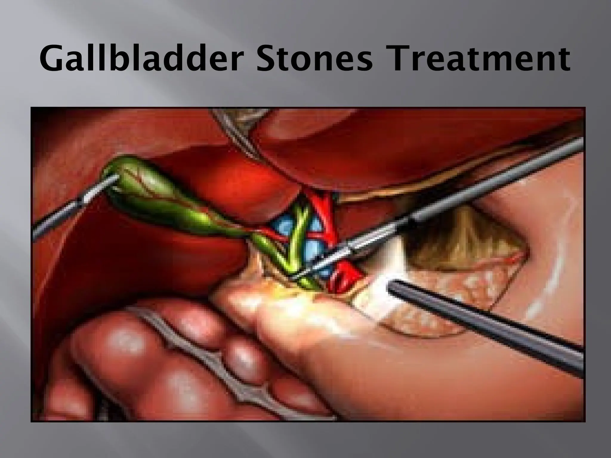 Understanding Gallbladder Stones and Treatment Options by Dr.pptx