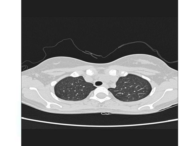 Understanding hrct | PPTX | Lung and Respiratory Health | Diseases and ...