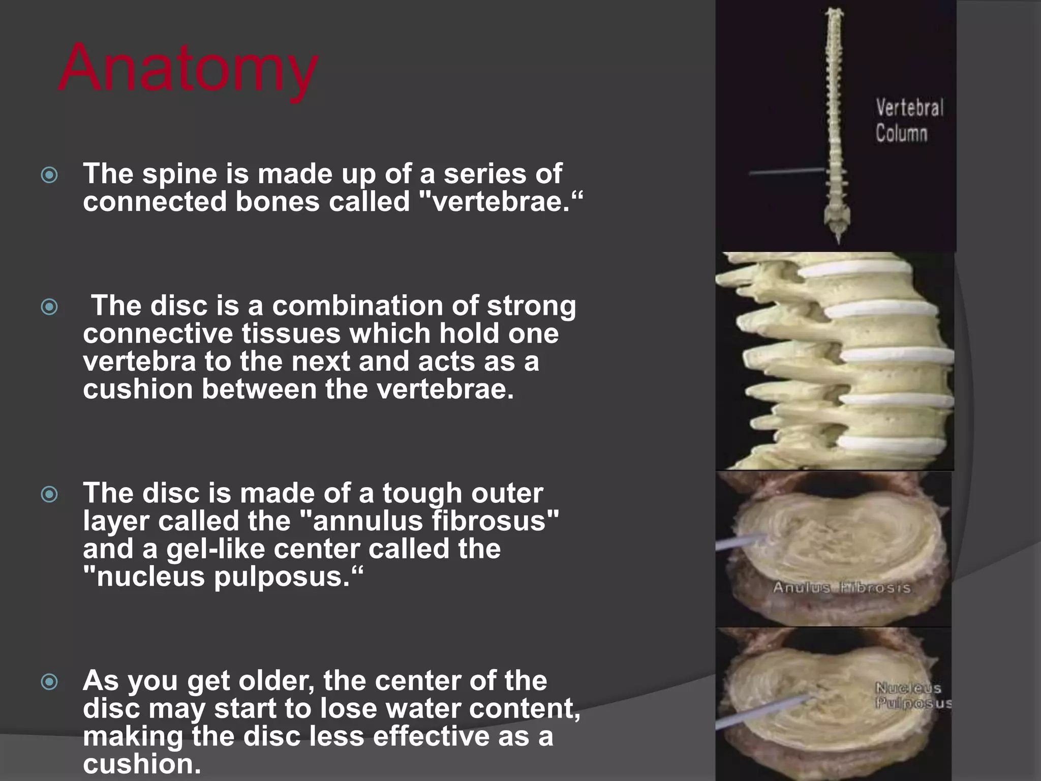 Understanding lumbar disc herniation | PPT