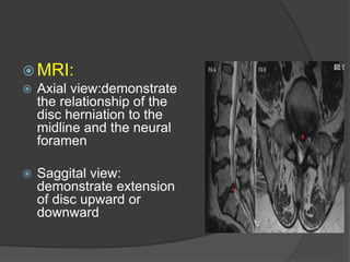Understanding lumbar disc herniation | PPT