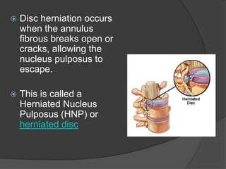 Understanding lumbar disc herniation | PPT