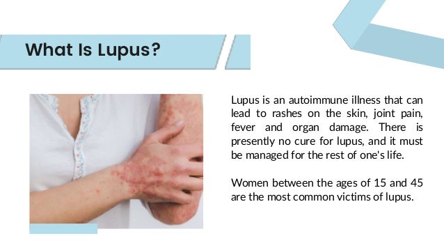 Understanding Lupus And Treatment With Stem Cells - Dr. David Greene R3 ...