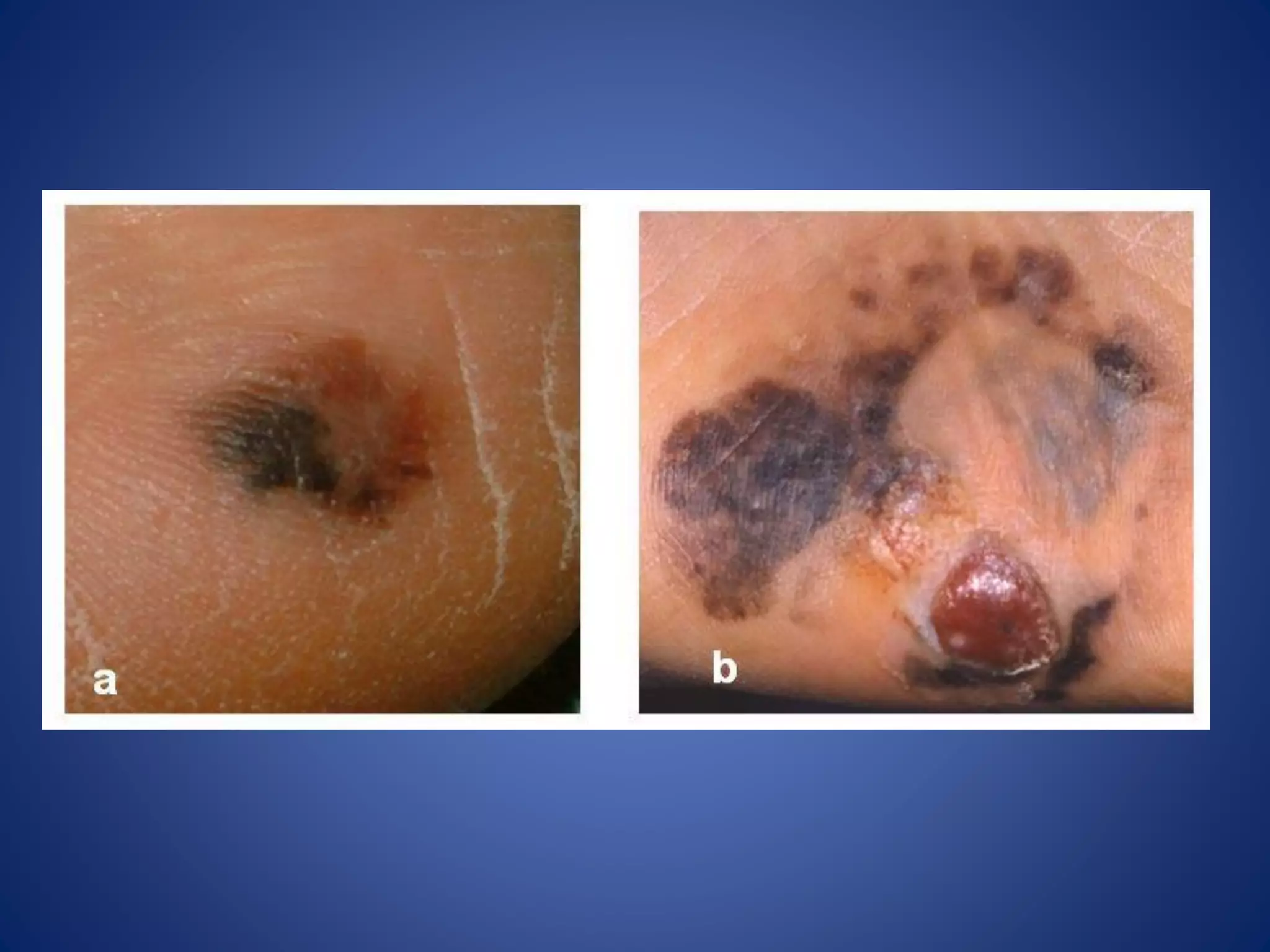 Melanoma Prevention, Screening and Diagnosis - Dr. Ana Ciurea | PDF