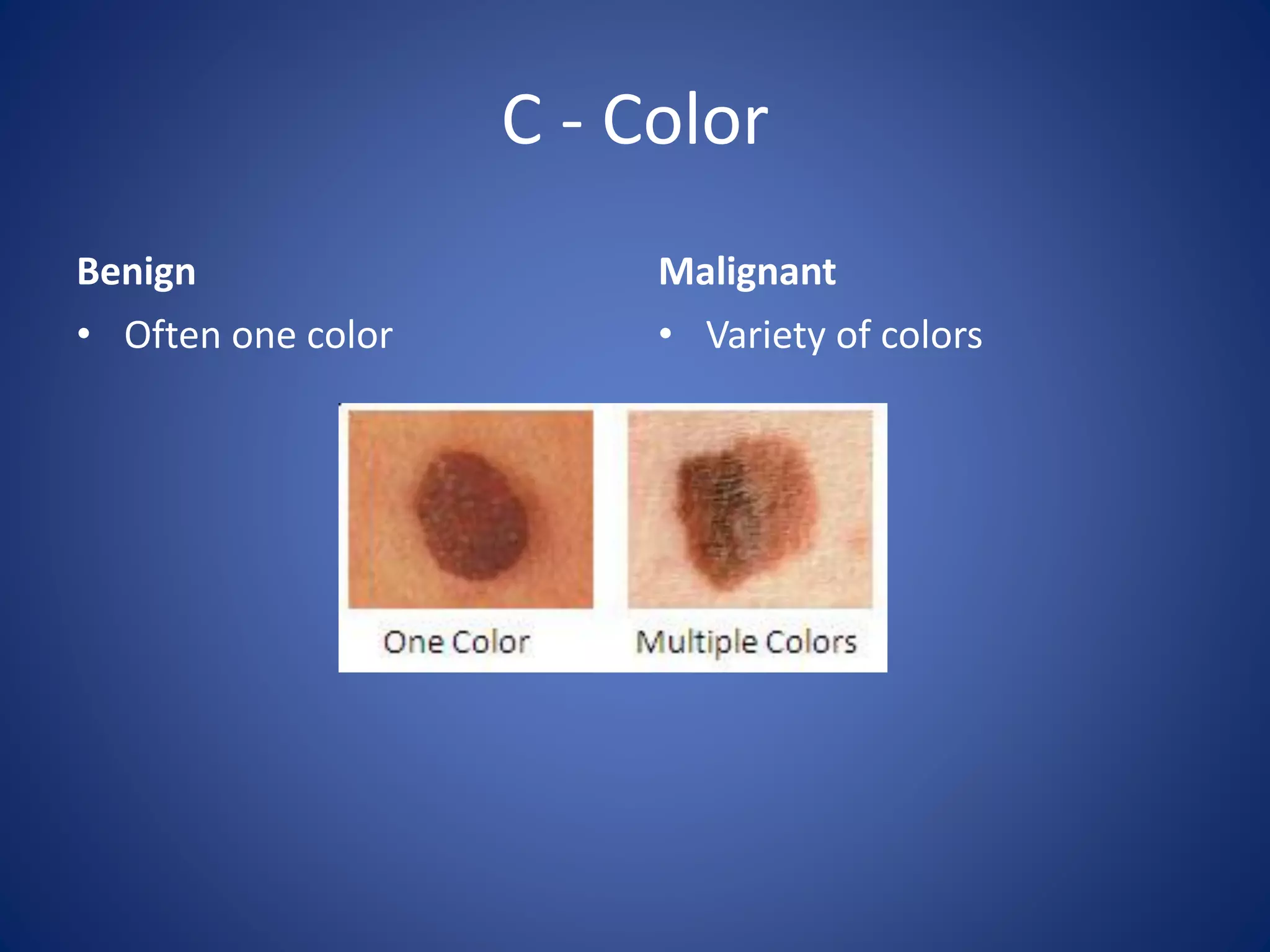 Melanoma Prevention, Screening and Diagnosis - Dr. Ana Ciurea | PDF