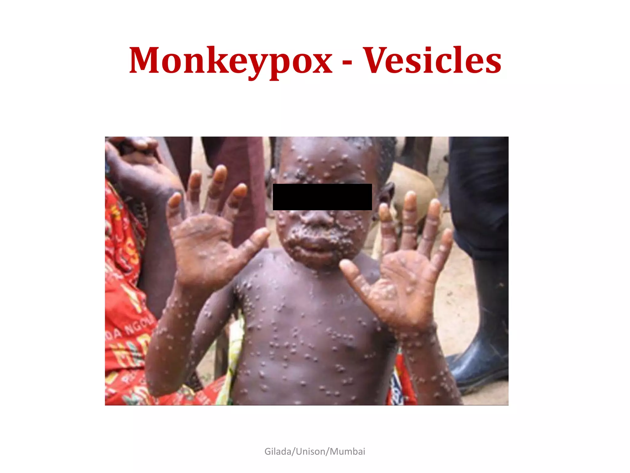 Understanding Monkeypox | PDF
