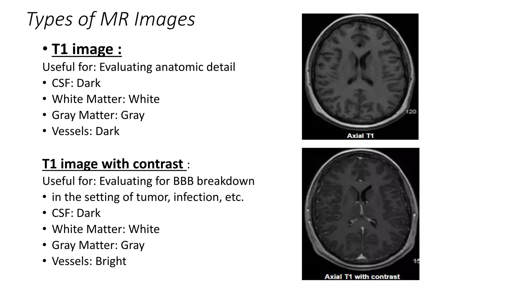 Understanding mri in neonate | PPTX