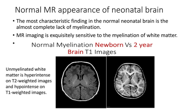 Understanding mri in neonate | PPTX