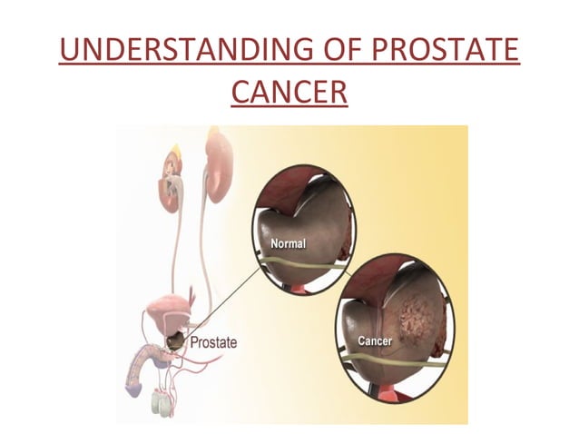 Understanding of prostate cancer | PPT