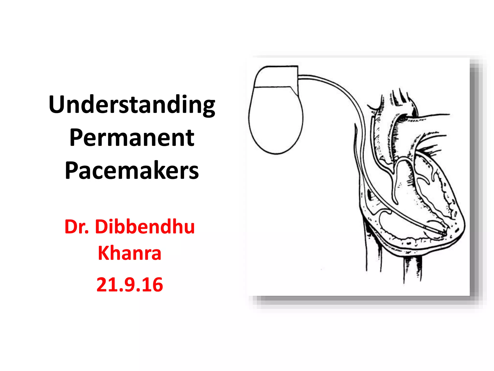 Understanding pacemakers | PPTX