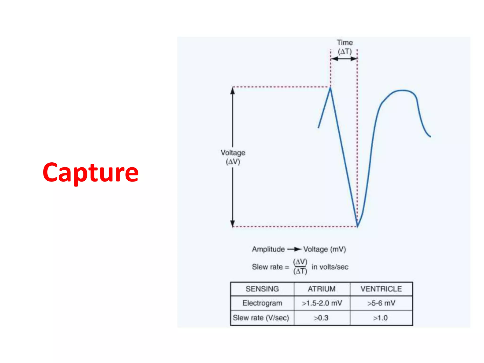 Understanding pacemakers | PPTX