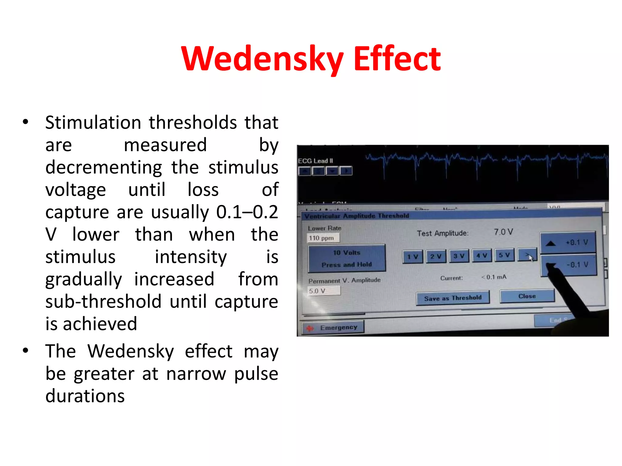 Understanding pacemakers | PPTX