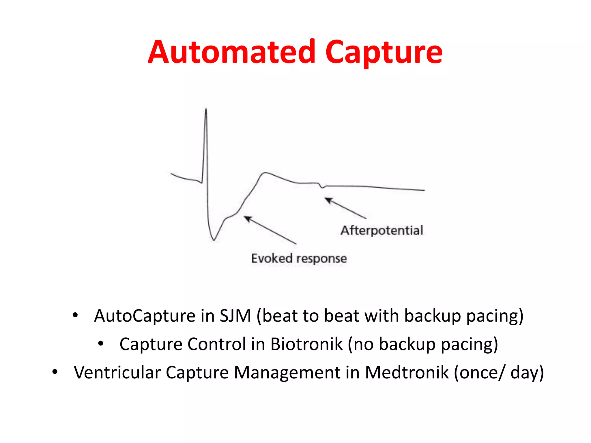 Understanding pacemakers | PPTX