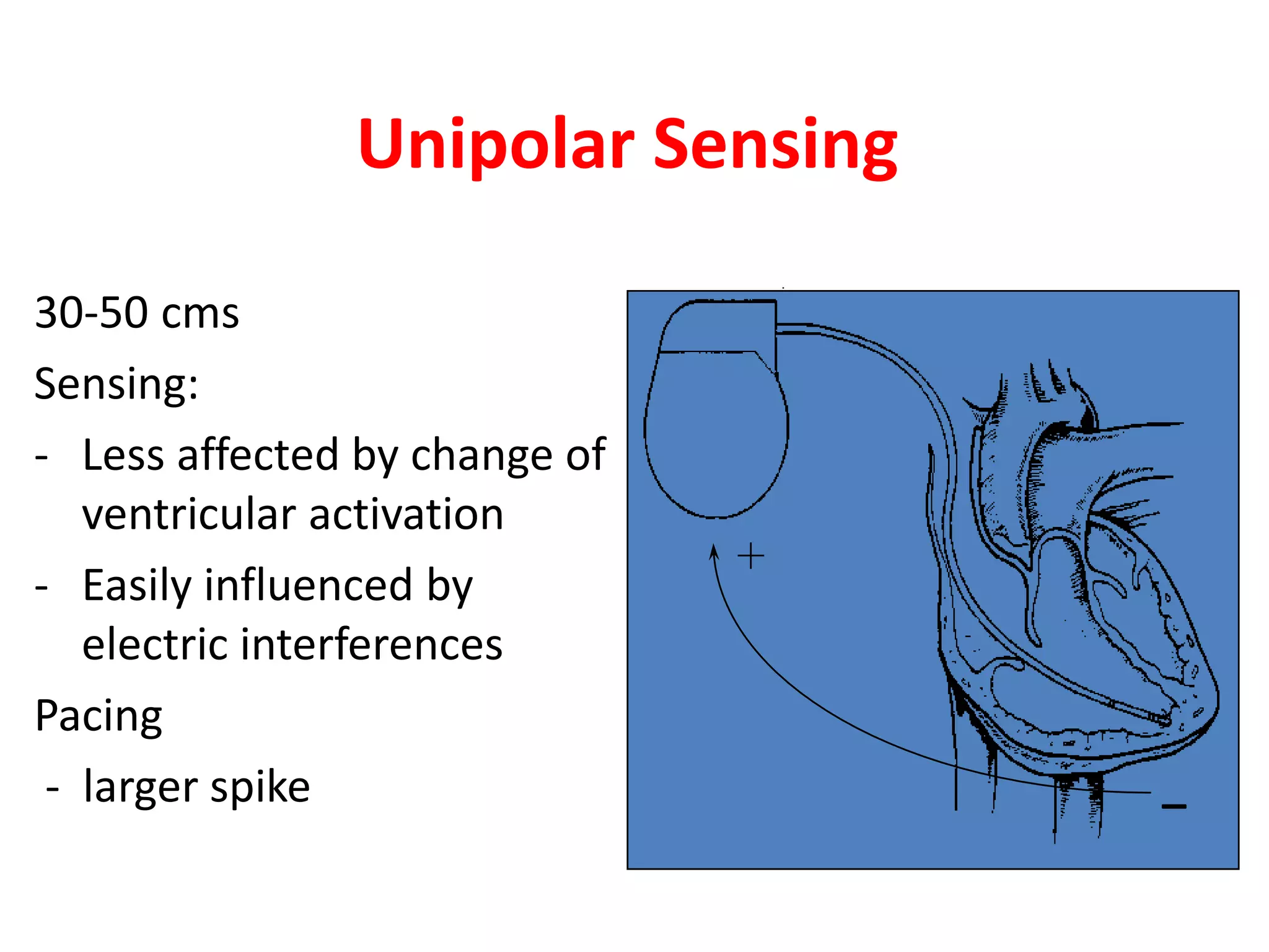 Understanding pacemakers | PPTX
