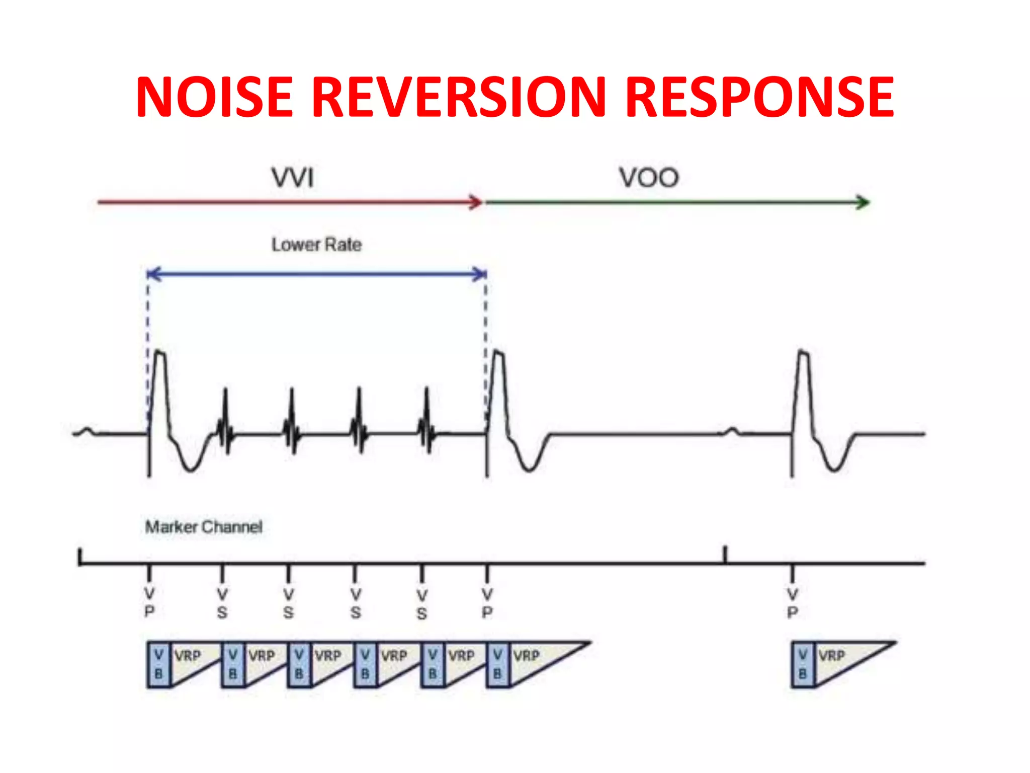 Understanding pacemakers | PPTX