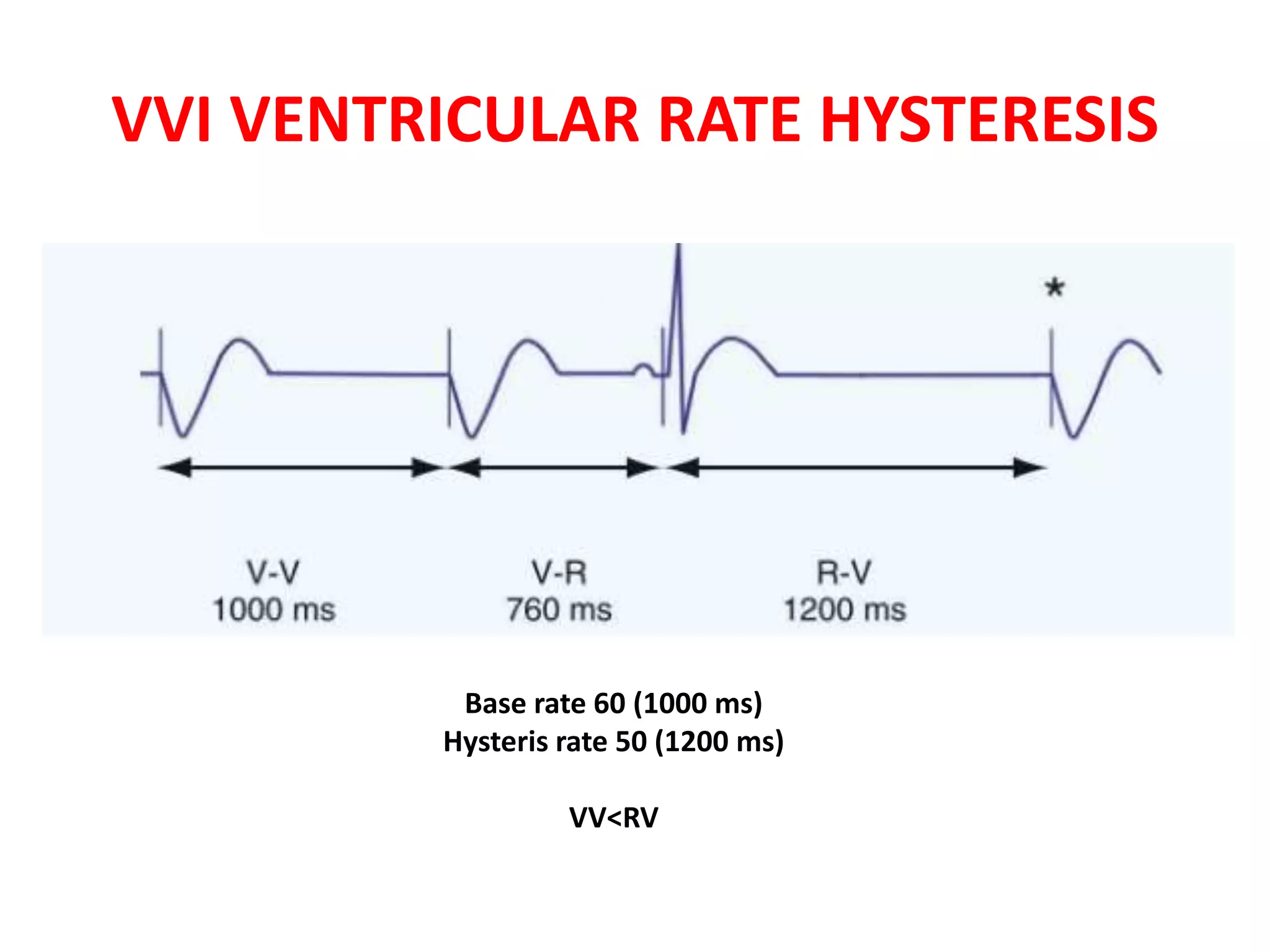 Understanding pacemakers | PPTX