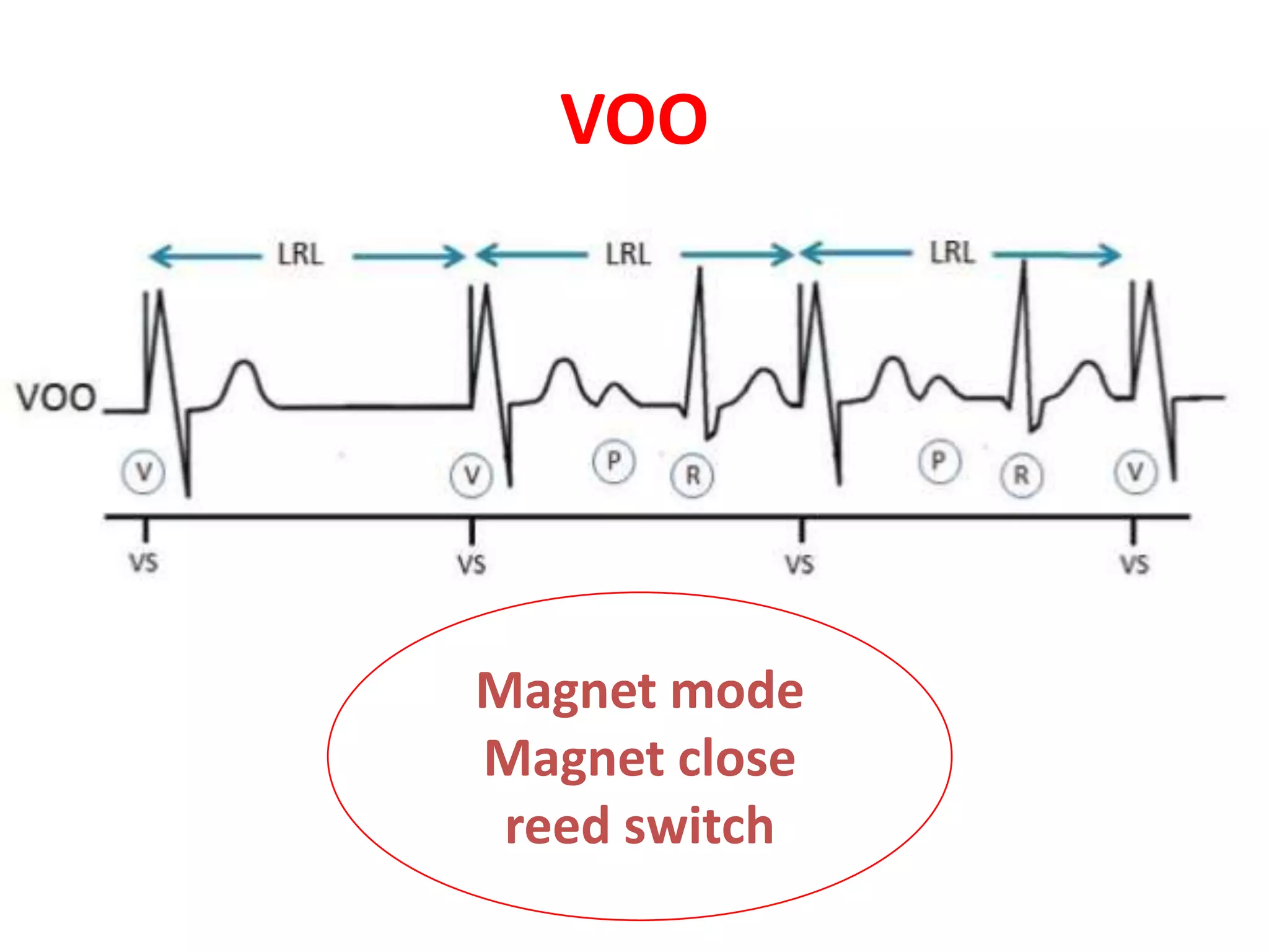 Understanding pacemakers | PPTX